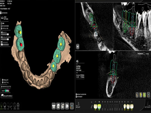 Chirurgie implantaire guidée - Implant dentaire - Dentiste Dieppe